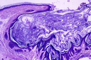 Dilated Pore Of Winer Workup Histologic Findings