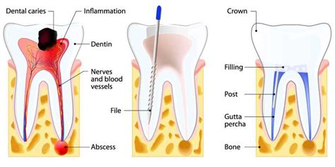 Root Canal Treatment What Is Root Canal Treatment Mayhew Dental