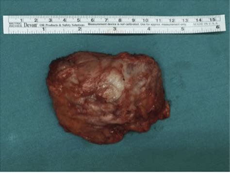 Macroscopic Appearance Of Elastofibroma Dorsi Download Scientific