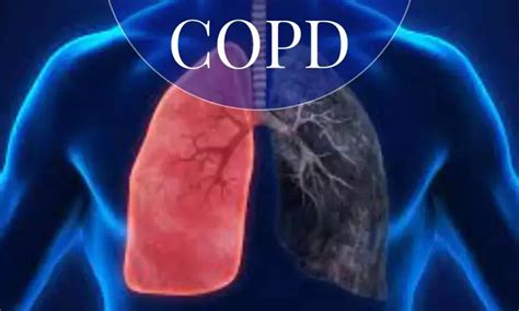 Asthma And Copd Management