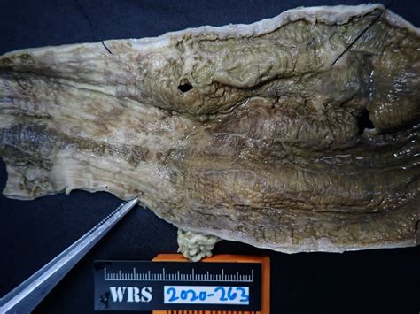 A Perforation On The Intestinal Wall On The Antimesenteric Border Seen