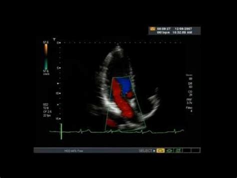 What To Expect From An Echocardiogram HubPages