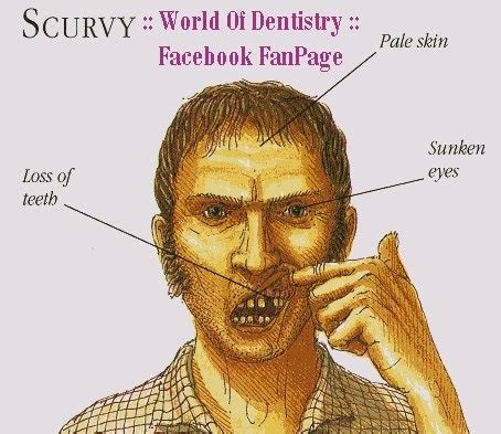 World Of Dentistry Scurvy Vitamin C Deficiency