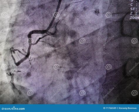 Stemi At Right Coronary Artery Stock Image Image Of Grafting Artery