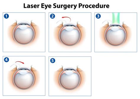 Getting To Know Lasik Surgery How Advance Eye Surgery Works Boston
