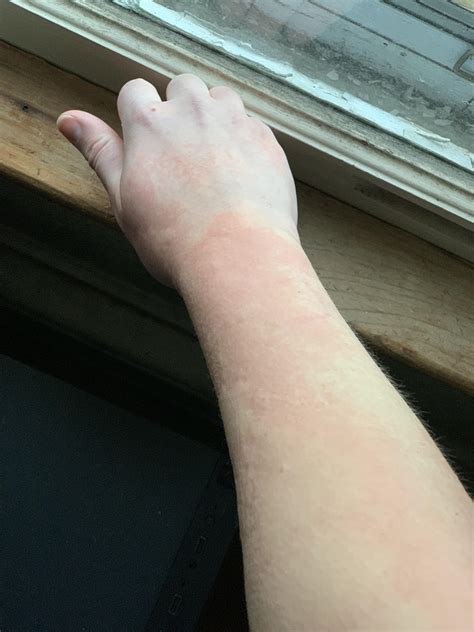 Aggressive Rash Immediately After Iv Why Is This Happening Scrolller