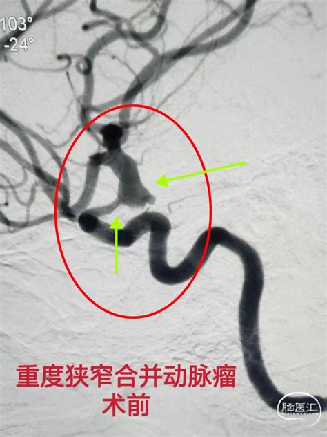 Answer技术治疗右侧颈内动脉末段重度狭窄合并动脉瘤 脑医汇