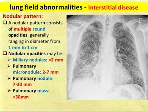 Lung Field Abnormalities Interstitial Disease Nodular Pattern A