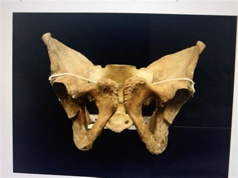 Could You Help Me Sex This Pelvic Bone Rforensics