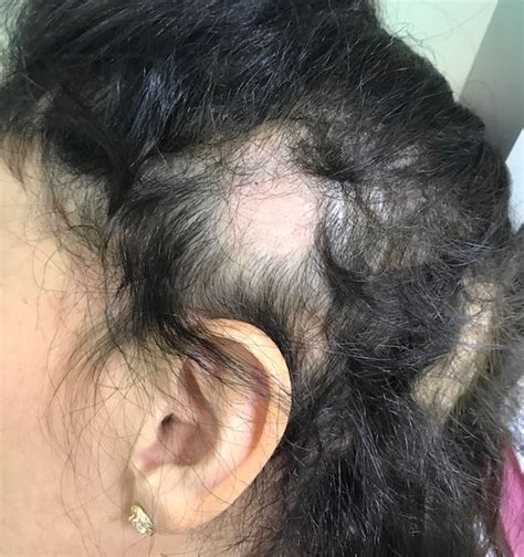 28 Questions With Answers In Alopecia Science Topic