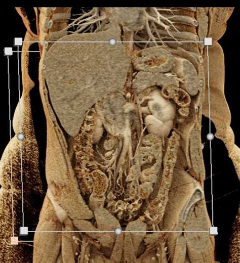 Vasculitis With Mesenteric Vascular Involvement Vascular Radiology