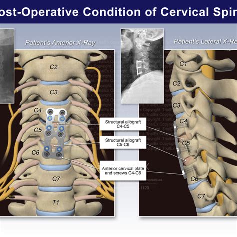 Medical Legal Exhibits Legal Animations And Trial Graphics Tria