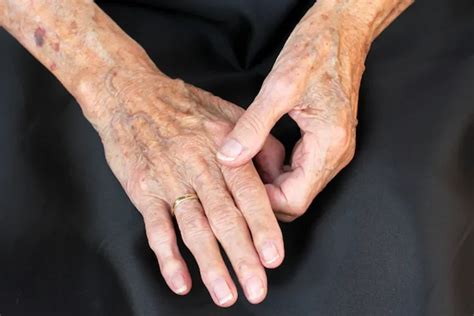 Causes And Treatment Of Ring Avulsion