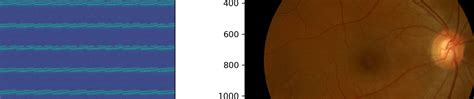 Eye Oct Datasets Kaggle