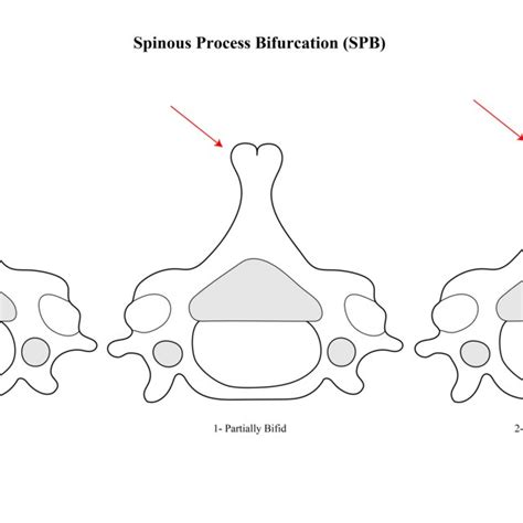 Spinous Process Bifurcation Spb Download Scientific Diagram