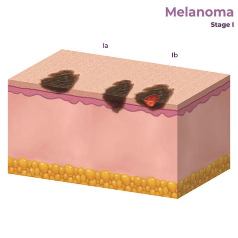 Stages Of Melanoma Aim At Melanoma Foundation