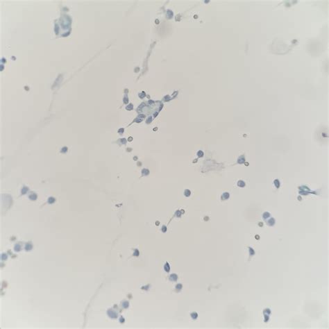 Csf Spun Specimen Answer In Comments Rpathology