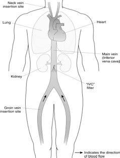 Inferior Vena Cava Ivc Filter Placement In Interventional Radiology