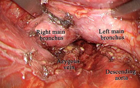 Subcarinal Lymph Node Dissection Via A Transhiatal Approach Under