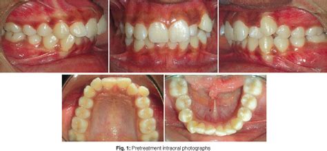 Figure 4 From Mini Implant Supported Molar Distalization Semantic Scholar