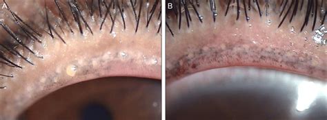 Eyelid Margin Disease Types And Treatment