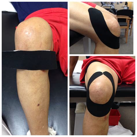 Got Knee Pain Try This Simple Taping Technique To Ease Your Pain