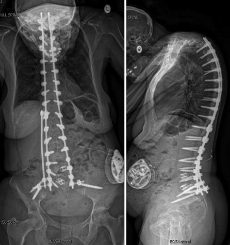 The Impact Of Baseline Cervical Malalignment On The Development Of