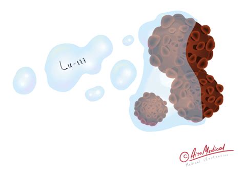 Lutetium 177 Psma Treatment For Prostate Cancer