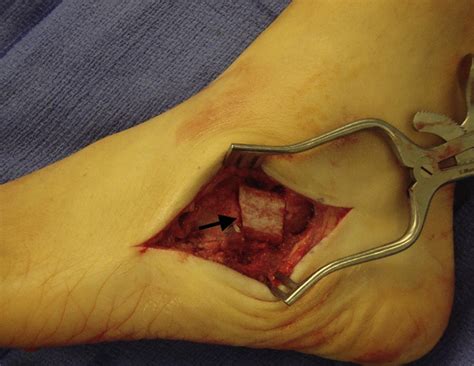 The Hindfoot Arch Radiologic Clinics