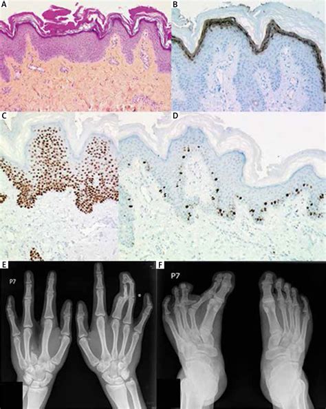Ectrodactyly Ectodermal Dysplasia Clefting Syndrome With Unusual Cutaneous Vitiligoid And