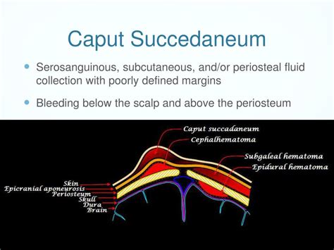 Ppt Cranial Complications In Newborns Powerpoint Presentation Free