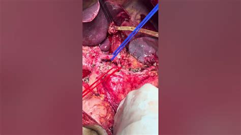 Total Gastrectomy With D2 Lymph Node Dissection Youtube