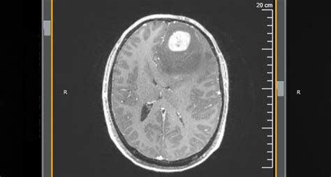 Cat Scan Brain Tumor