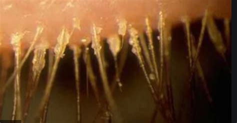 Parasitic Blepharitis