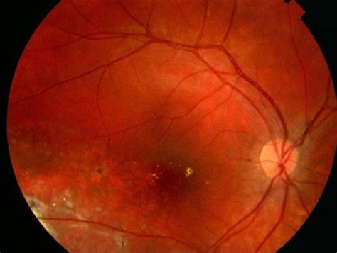 Primary Retinal Telangiectasia Nzoptics