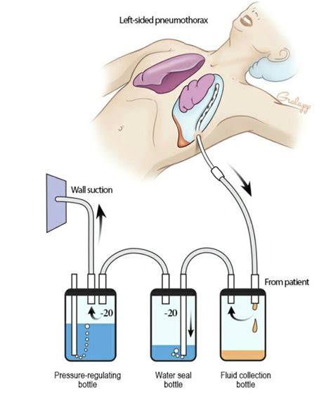 Chest Tube Clamp Vs Water Seal At Alberto Stark Blog
