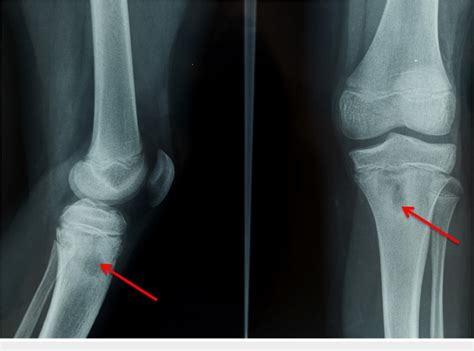 Knee Radiographs At Two Years Follow Up Osteomyelitis Of The Proximal