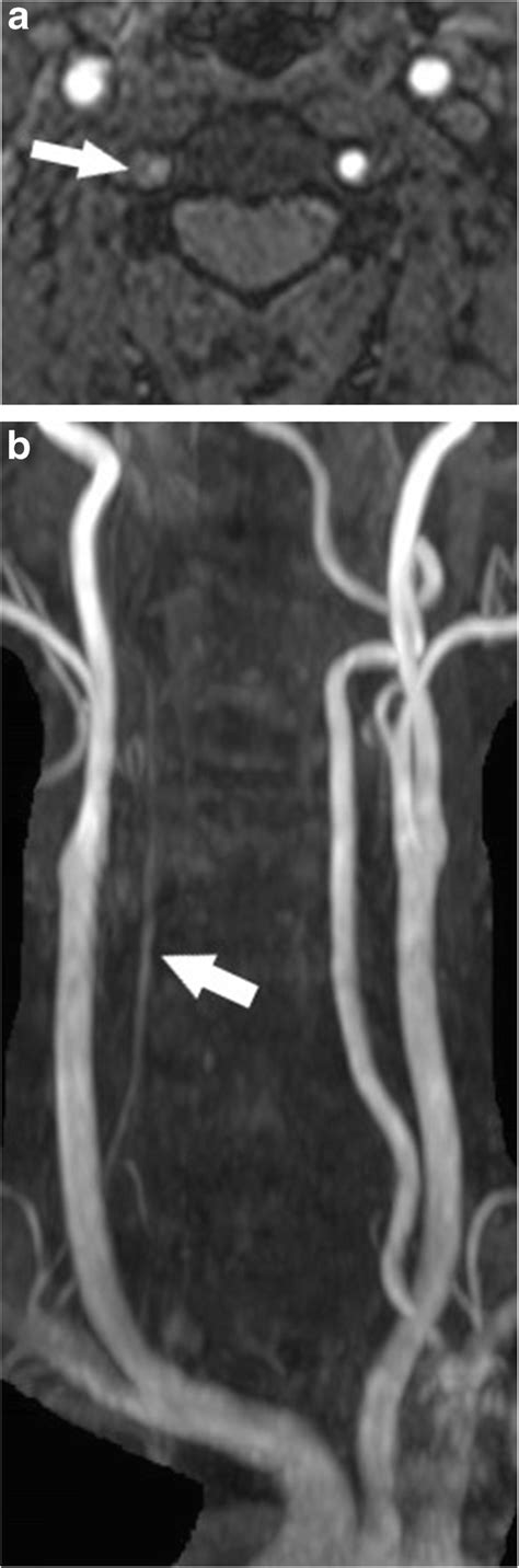 Va Dissection Axial B And Mip Reconstruction B From 3d Time Of Download Scientific Diagram