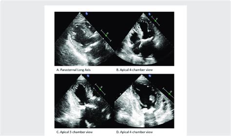 Transthoracic Echocardiogram Showing Apical Ballooning Download