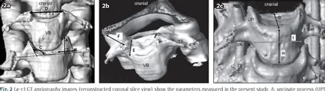 Uncinate Process Vertebra