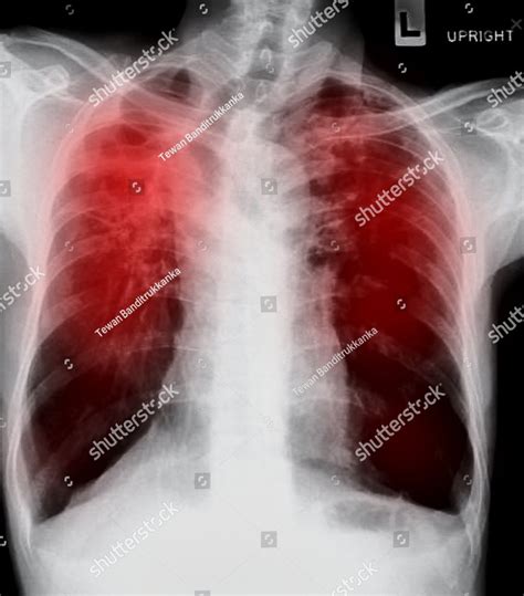 Pulmonary Tuberculosis Film Chest X Ray Show Interstitial Infiltration Both Lung Due To