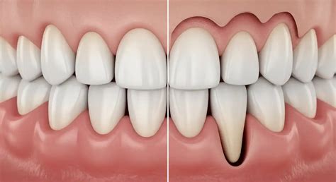 Can Receding Gums Grow Back Causes And Prevention