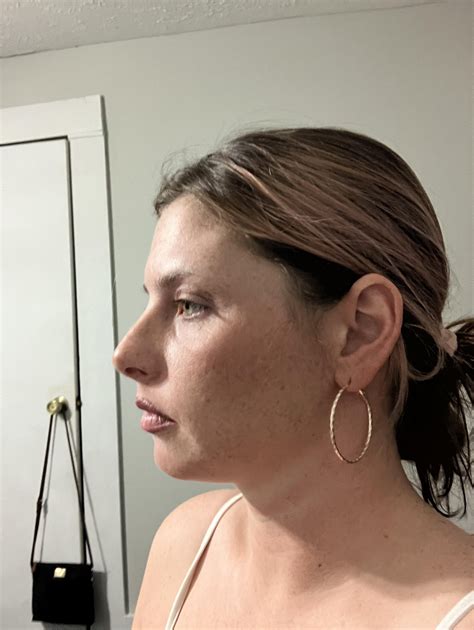 Nose Looks Diff From Each Side Rnoses