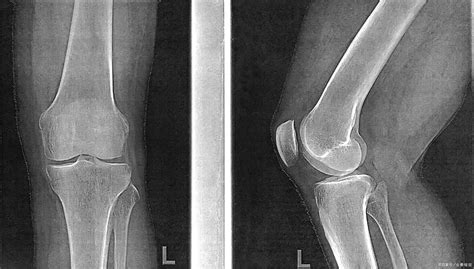 滑囊炎是怎么回事？盘点滑囊炎的7大症状，为了健康多了解