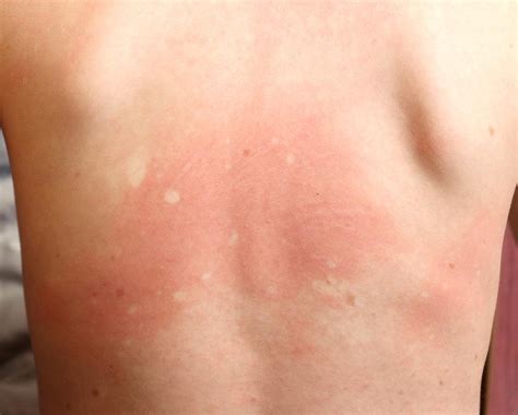 Hypopigmentation Back