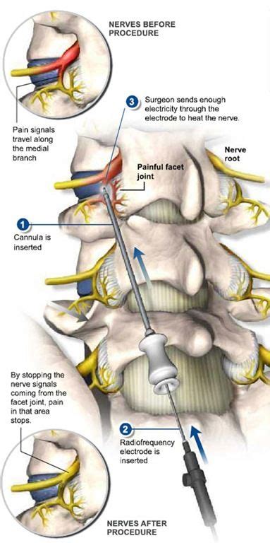 Radiofrequency Ablation Of The Medial Branch Nerves Artofit