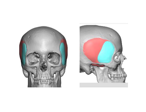 Technical Strategies Extended Temporal Implants Explore Plastic Surgery