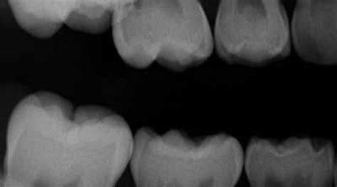 Orthodontic Options For The Ectopic Eruption Of A Maxillary First Molar Dentistry Iq