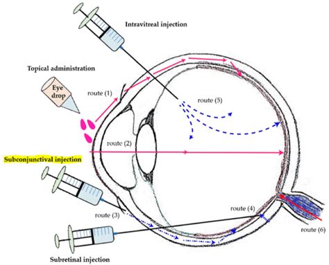 Subconjunctival Injection