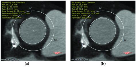 A Sinotubular Junction And B Proximal Ascending Aorta Evaluated By Download Scientific